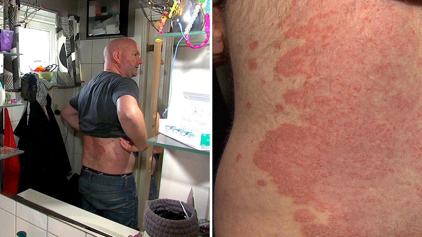Sådan genkender du tegnene på alvorlig psoriasis | TV2 ØST Sådan genkender du tegnene på alvorlig psoriasis | TV2 ØST